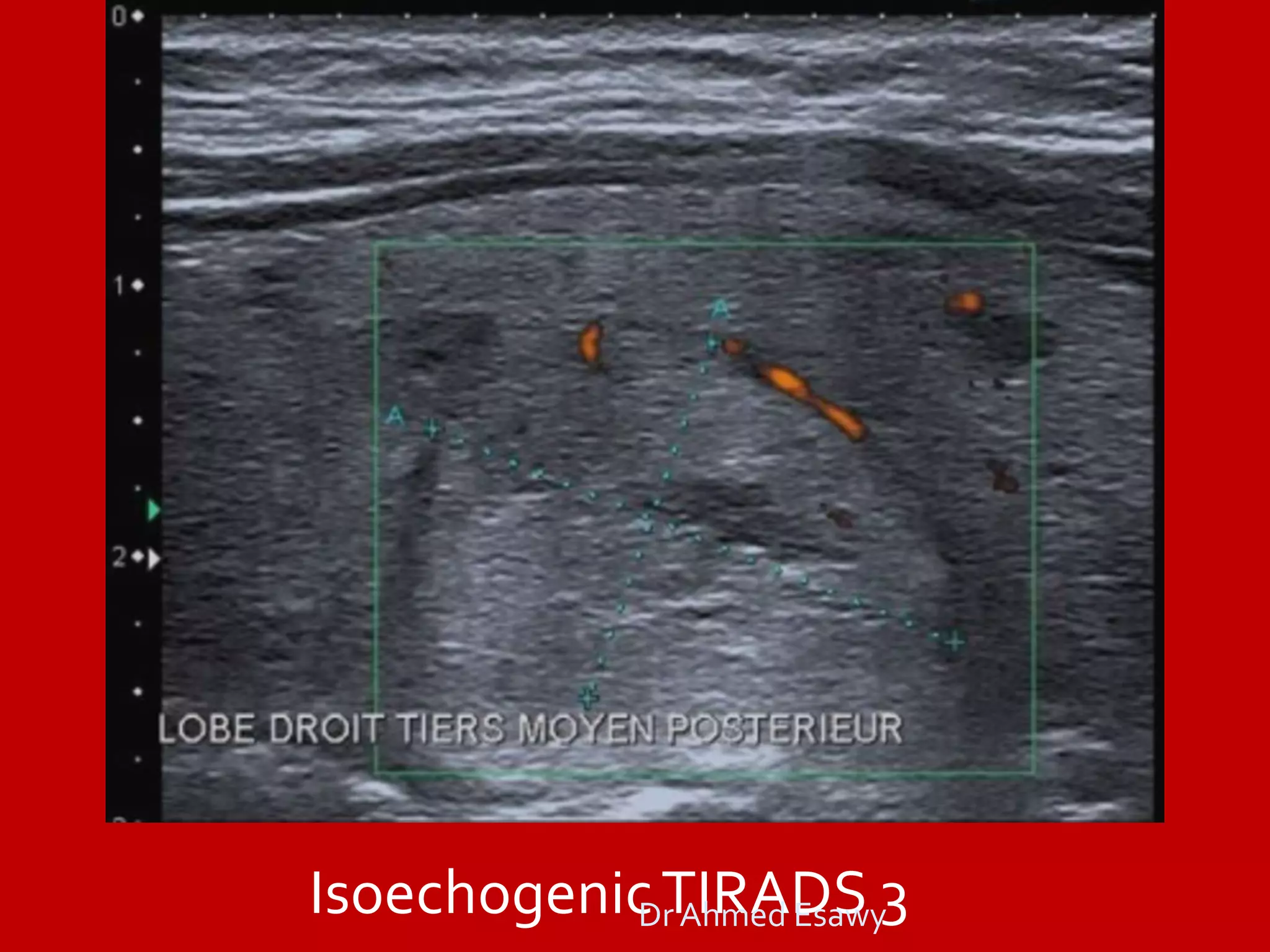 TIRADS (thyroid nodule imaging reporting and data system) Dr Ahmed ...