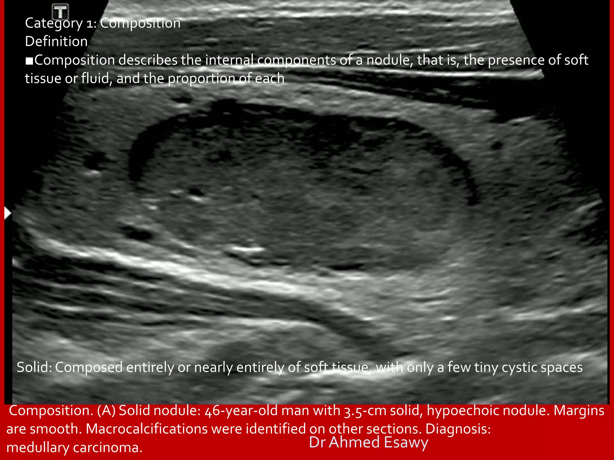 TIRADS (thyroid nodule imaging reporting and data system) Dr Ahmed ...