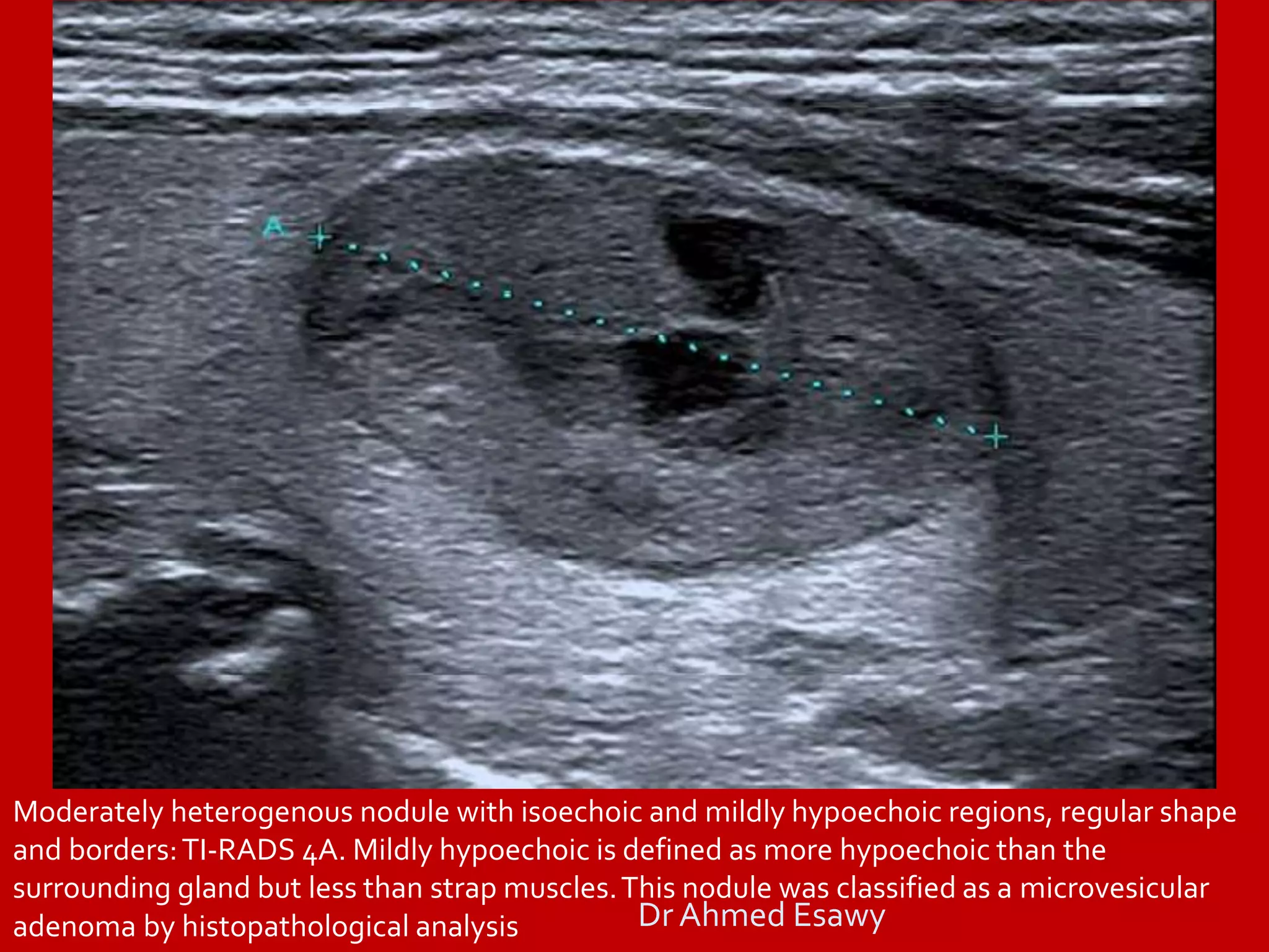 TIRADS (thyroid nodule imaging reporting and data system) Dr Ahmed ...