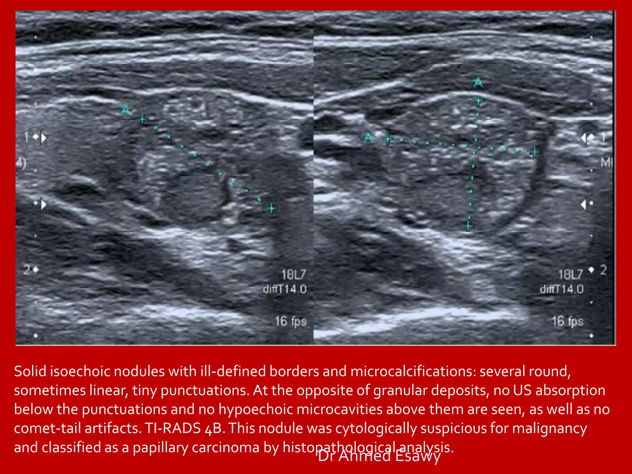 TIRADS (thyroid nodule imaging reporting and data system) Dr Ahmed ...