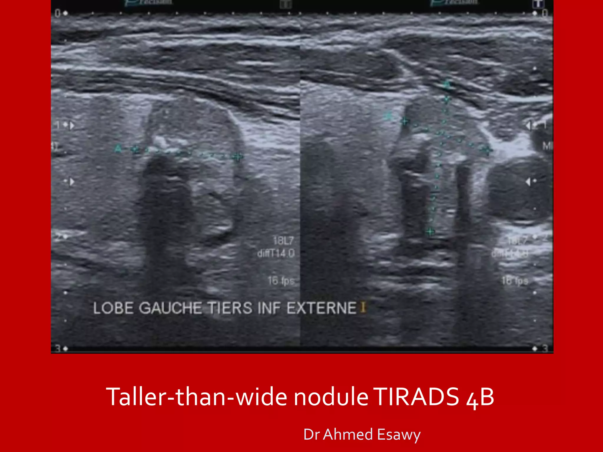 TIRADS (thyroid nodule imaging reporting and data system) Dr Ahmed ...