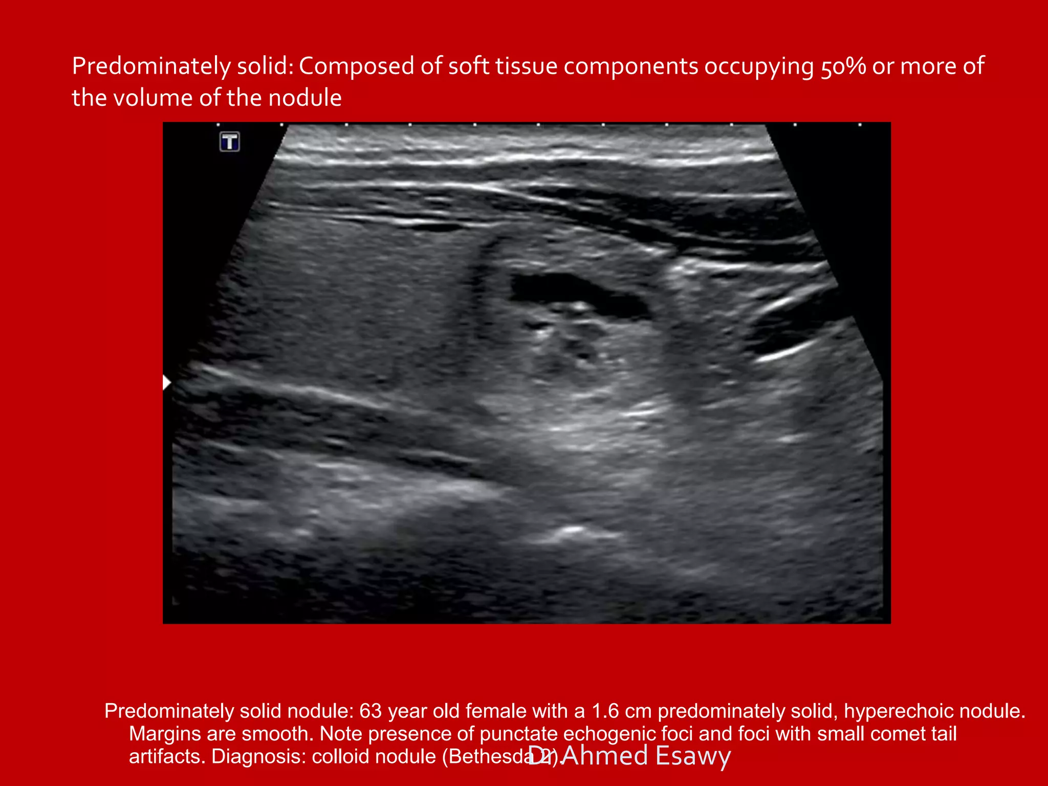 TIRADS (thyroid nodule imaging reporting and data system) Dr Ahmed ...