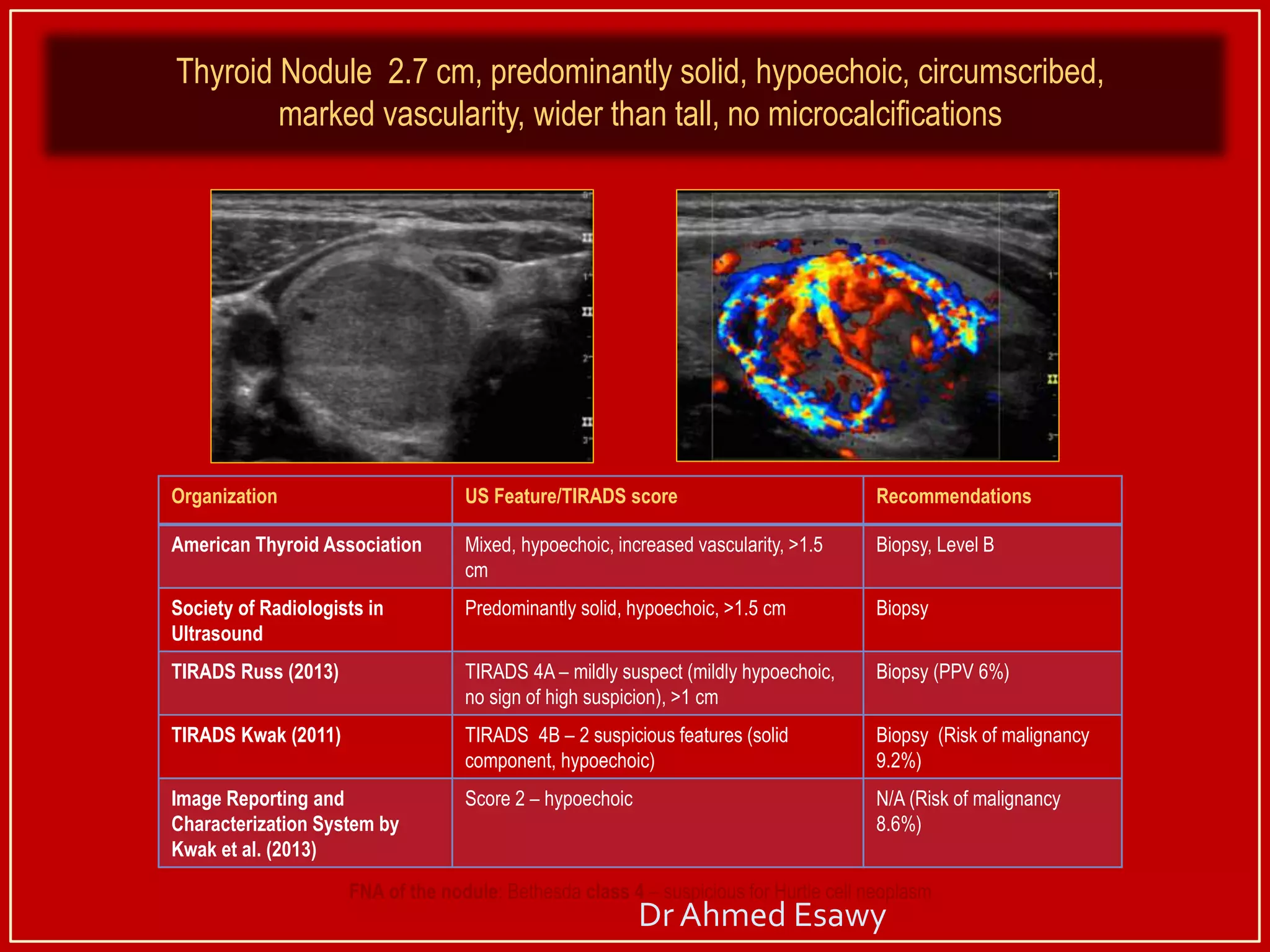 TIRADS (thyroid nodule imaging reporting and data system) Dr Ahmed ...