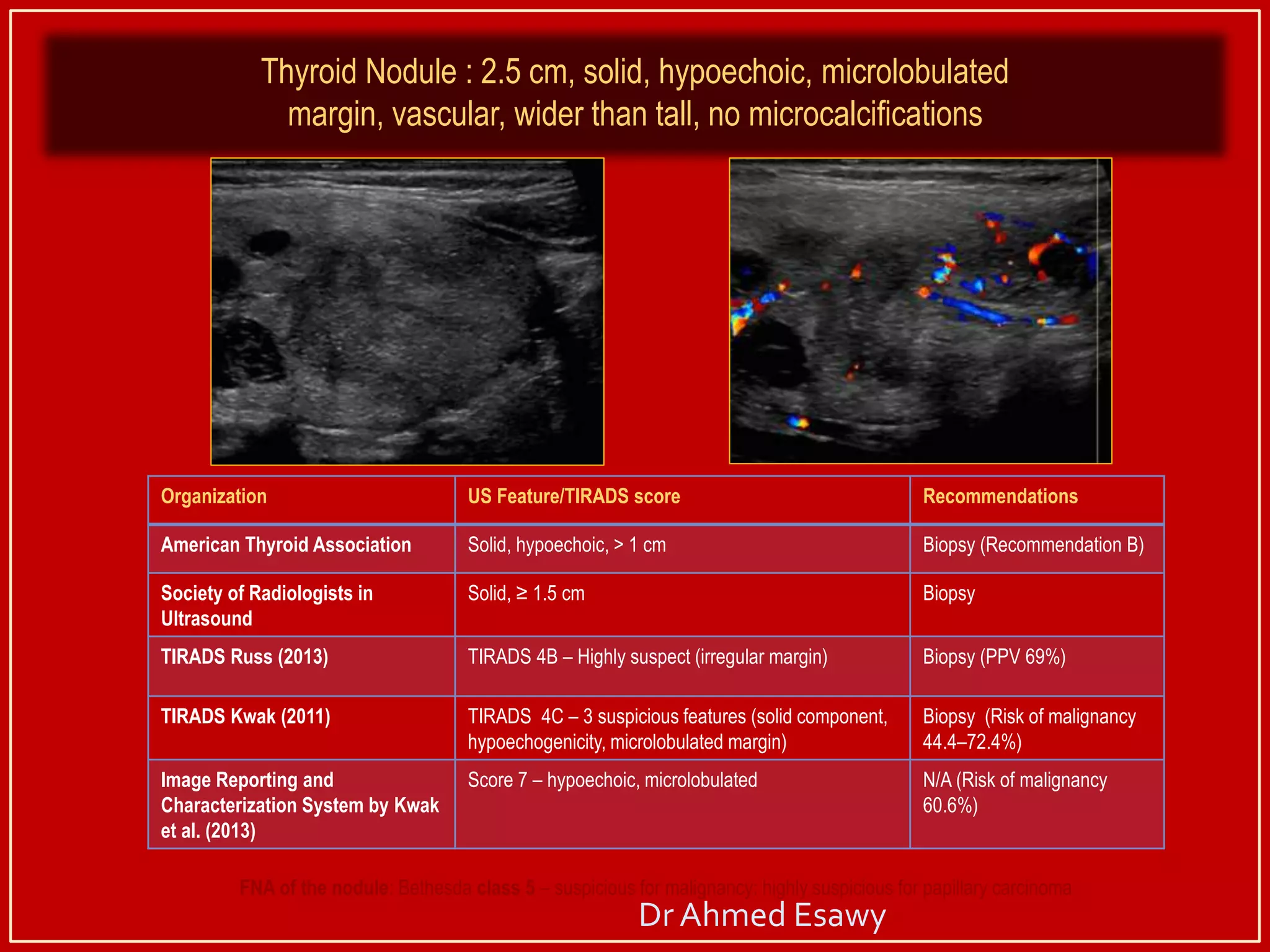 TIRADS (thyroid nodule imaging reporting and data system) Dr Ahmed ...