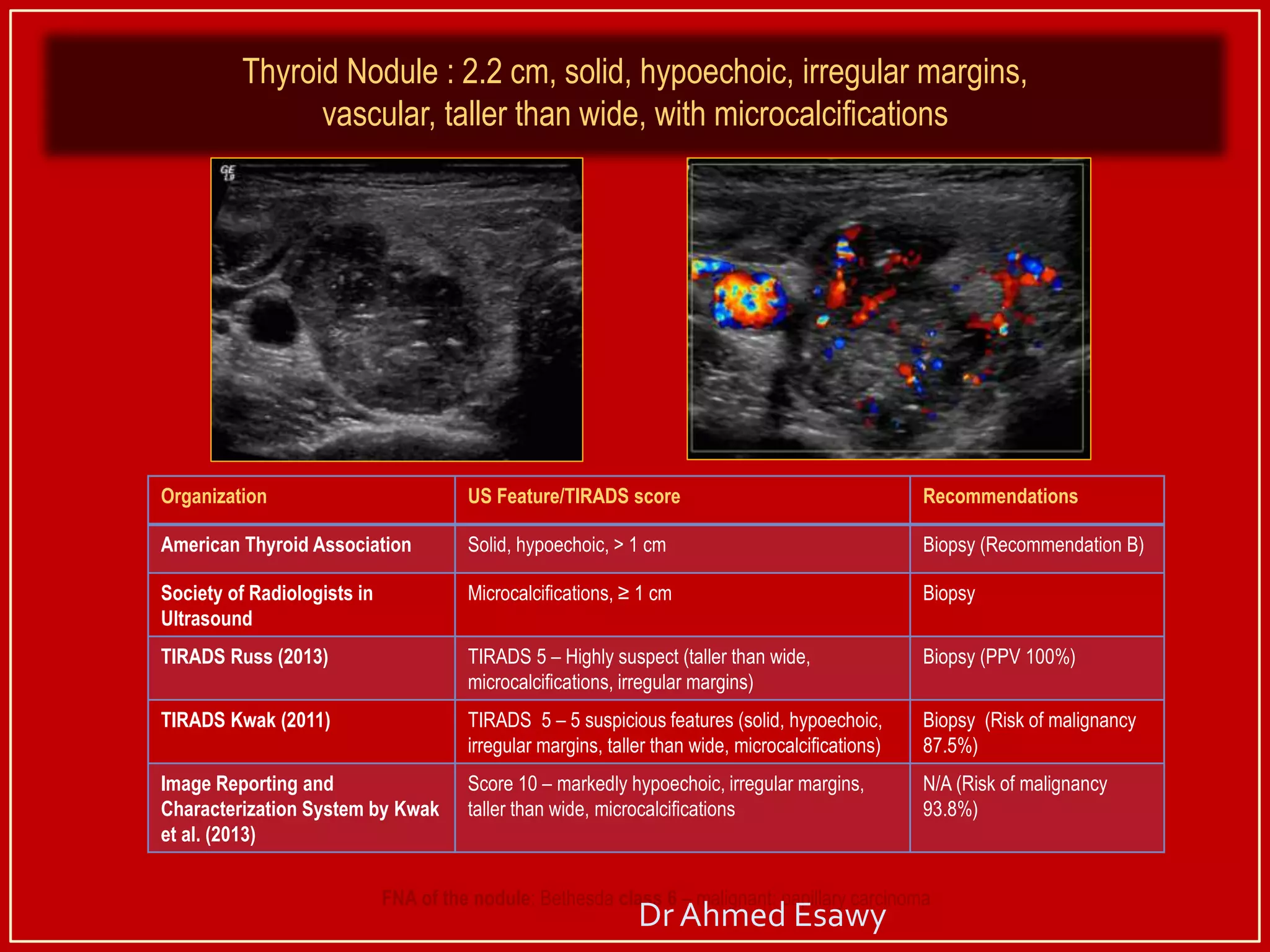 TIRADS (thyroid nodule imaging reporting and data system) Dr Ahmed ...