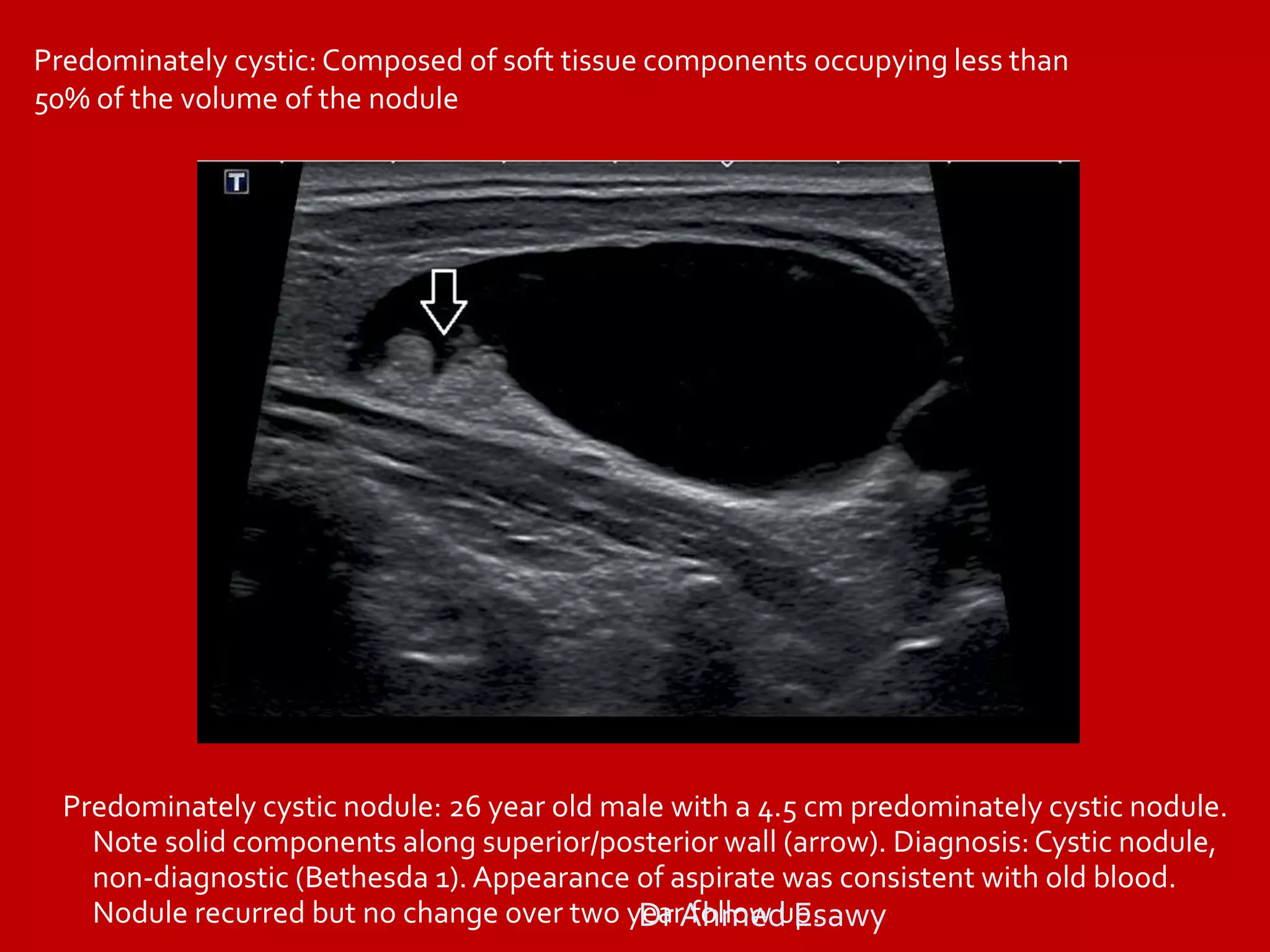 TIRADS (thyroid nodule imaging reporting and data system) Dr Ahmed ...