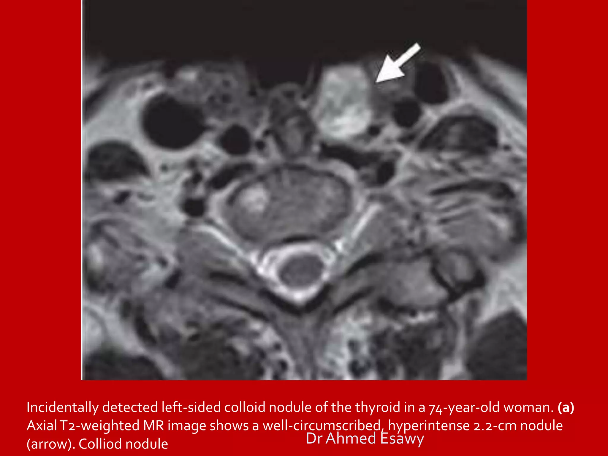 TIRADS (thyroid nodule imaging reporting and data system) Dr Ahmed ...