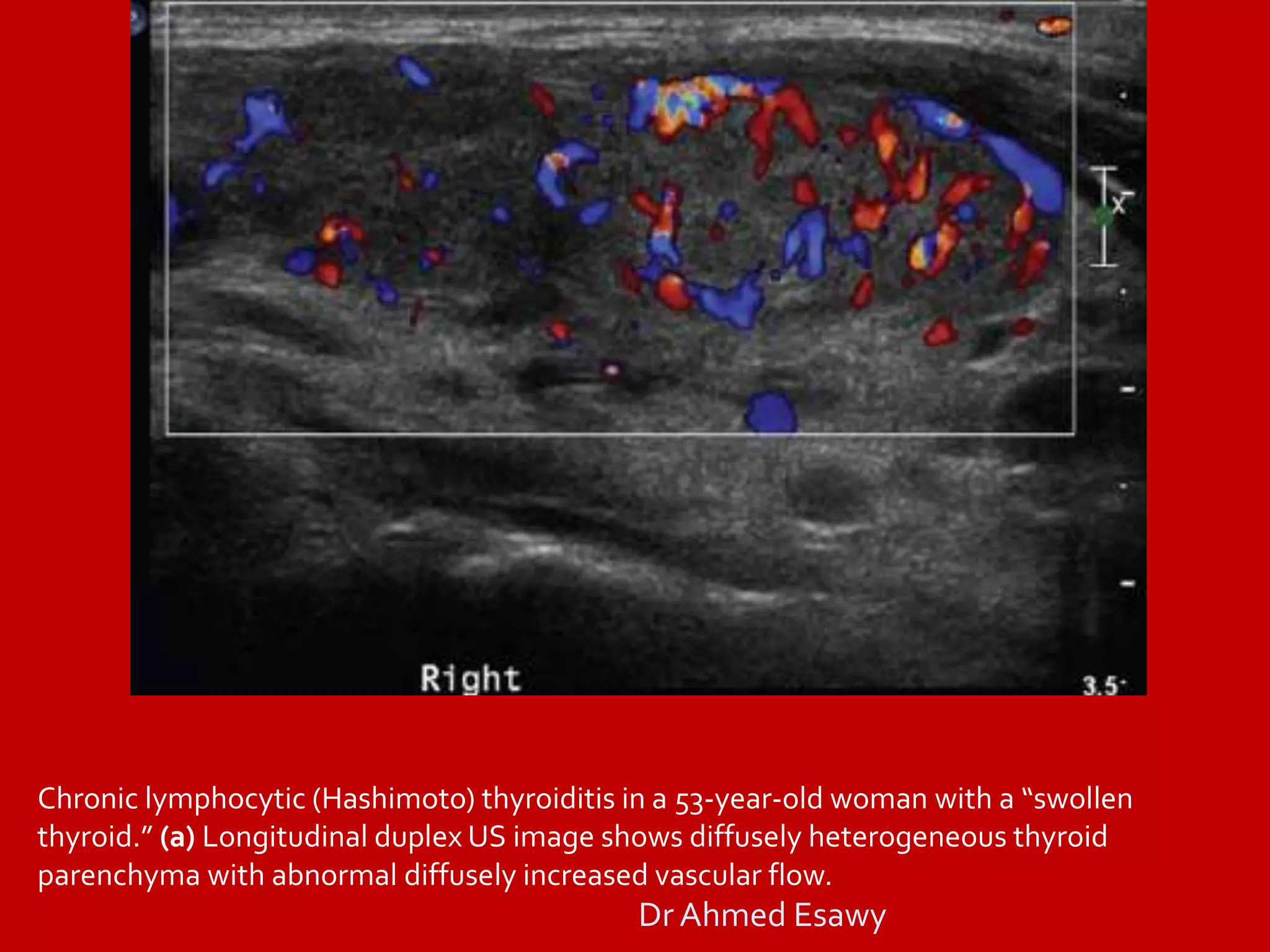 TIRADS (thyroid nodule imaging reporting and data system) Dr Ahmed ...