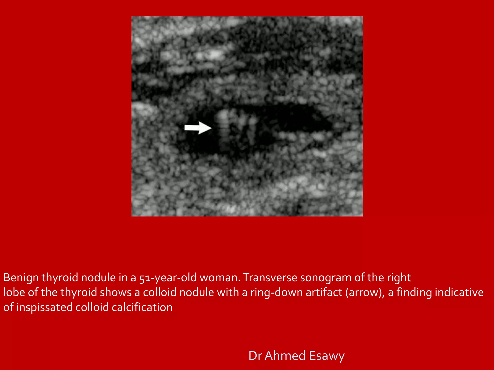 TIRADS (thyroid nodule imaging reporting and data system) Dr Ahmed ...