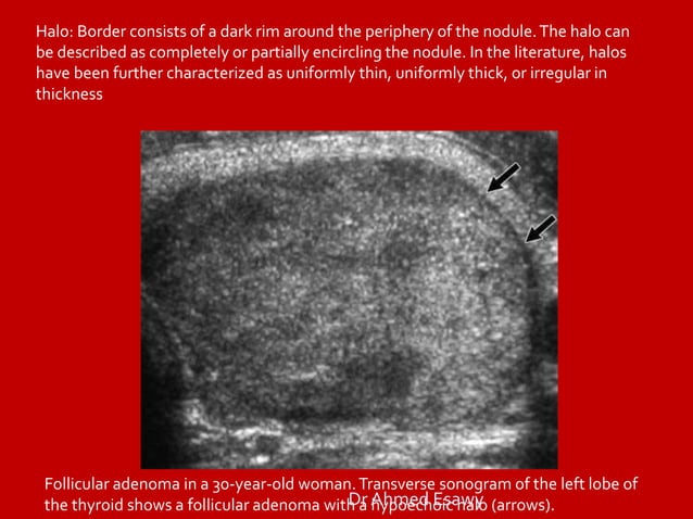 TIRADS (thyroid nodule imaging reporting and data system) Dr Ahmed ...