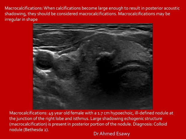 TIRADS (thyroid nodule imaging reporting and data system) Dr Ahmed ...