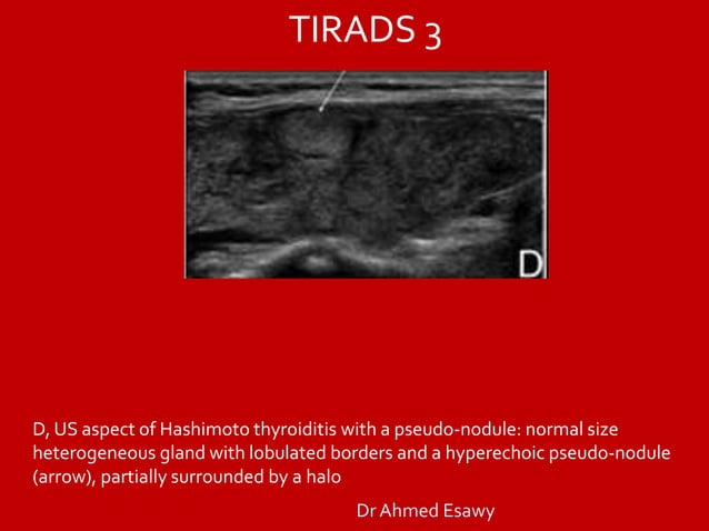 TIRADS (thyroid nodule imaging reporting and data system) Dr Ahmed ...