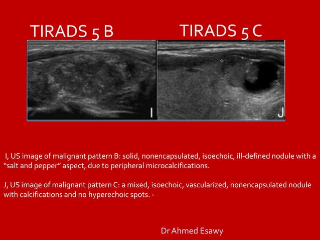 TIRADS (thyroid nodule imaging reporting and data system) Dr Ahmed ...