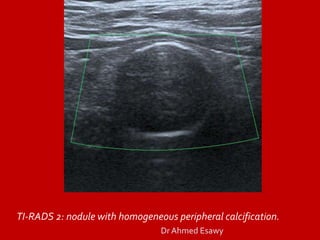 TIRADS (thyroid nodule imaging reporting and data system) Dr Ahmed ...