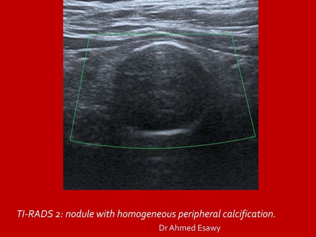 TIRADS (thyroid nodule imaging reporting and data system) Dr Ahmed ...