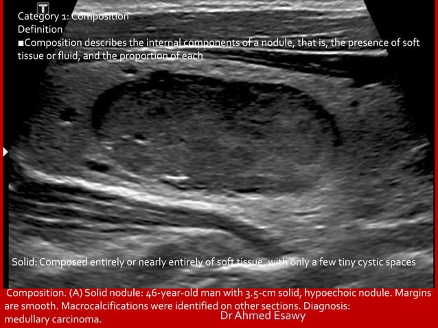 TIRADS (thyroid nodule imaging reporting and data system) Dr Ahmed ...
