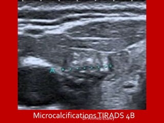 TIRADS (thyroid nodule imaging reporting and data system) Dr Ahmed ...