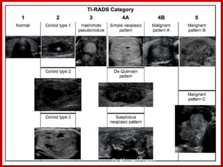 TIRADS (thyroid nodule imaging reporting and data system) Dr Ahmed ...