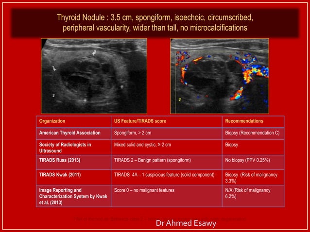 TIRADS (thyroid nodule imaging reporting and data system) Dr Ahmed Esawy