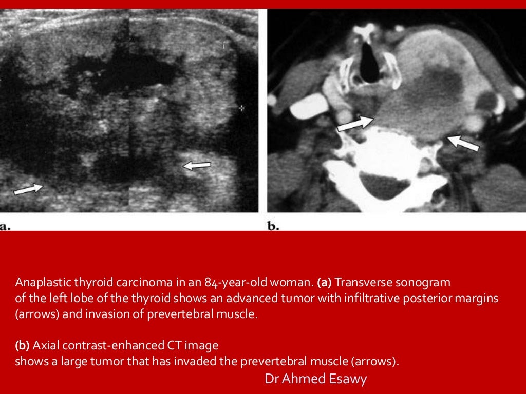 TIRADS (thyroid nodule imaging reporting and data system) Dr Ahmed E…