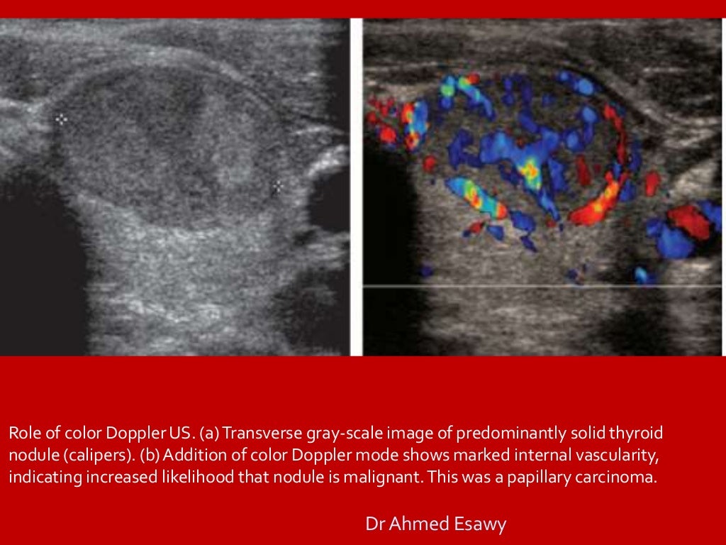 TIRADS (thyroid nodule imaging reporting and data system) Dr Ahmed E…