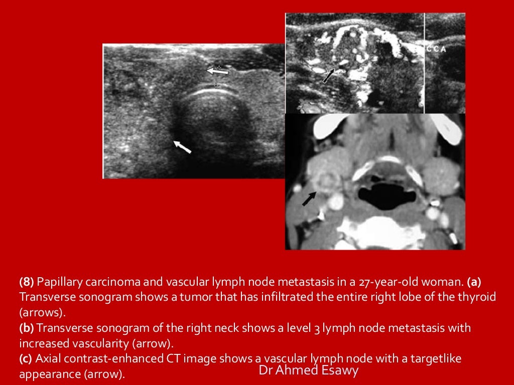 TIRADS (thyroid nodule imaging reporting and data system) Dr Ahmed E…