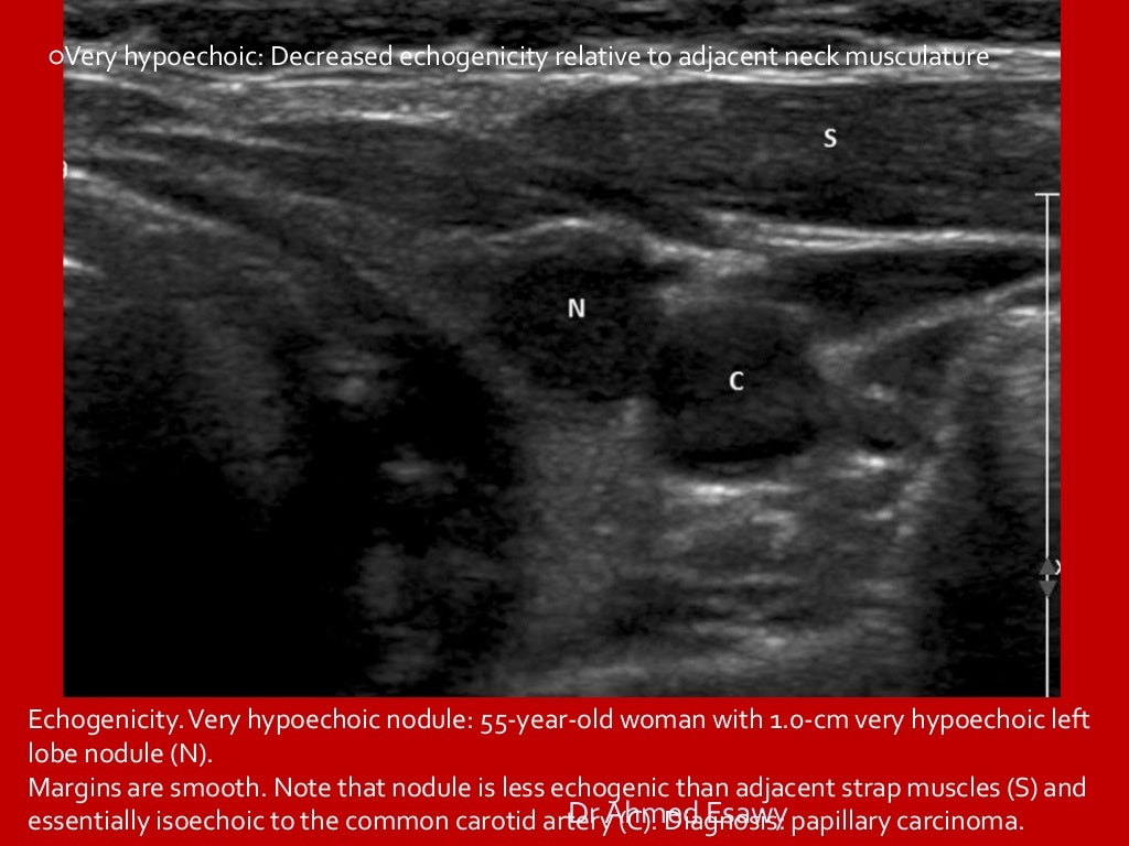 TIRADS (thyroid nodule imaging reporting and data system) Dr Ahmed E…