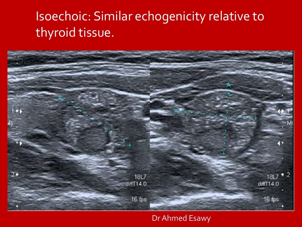 TIRADS (thyroid nodule imaging reporting and data system) Dr Ahmed E…