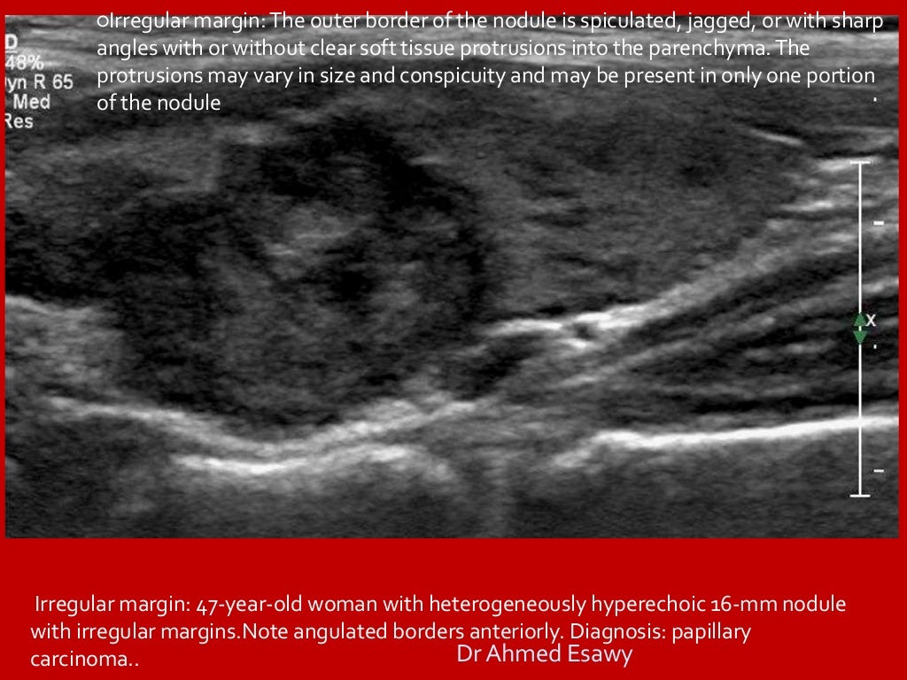 TIRADS (thyroid nodule imaging reporting and data system) Dr Ahmed E…