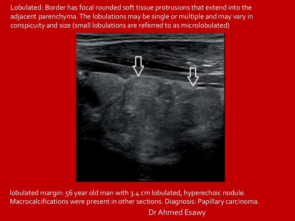 TIRADS (thyroid nodule imaging reporting and data system) Dr Ahmed E…