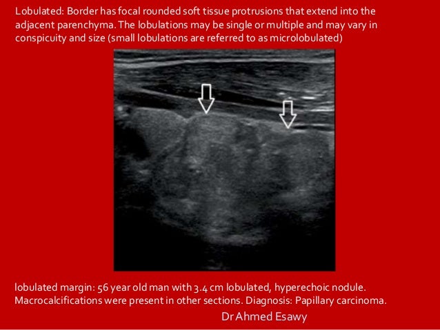 TIRADS (thyroid nodule imaging reporting and data system) Dr Ahmed E…