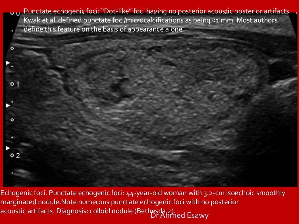 TIRADS (thyroid nodule imaging reporting and data system) Dr Ahmed E…