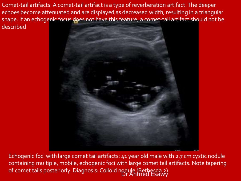 Tirads Thyroid Nodule Imaging Reporting And Data System Dr Ahmed E