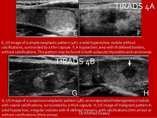 TIRADS (thyroid nodule imaging reporting and data system) Dr Ahmed E…