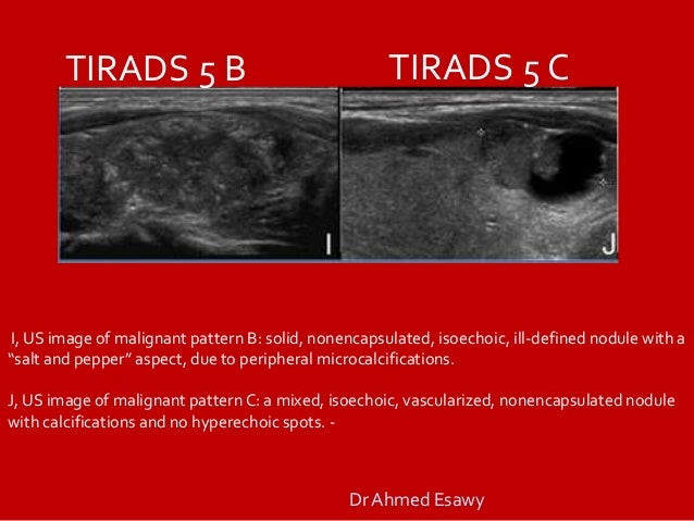 TIRADS (thyroid nodule imaging reporting and data system) Dr Ahmed E…