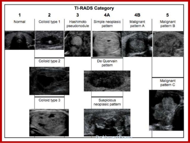 TIRADS (thyroid nodule imaging reporting and data system) Dr Ahmed E…