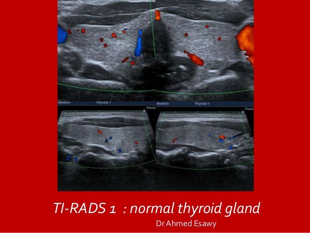 TIRADS (thyroid nodule imaging reporting and data system) Dr Ahmed E…