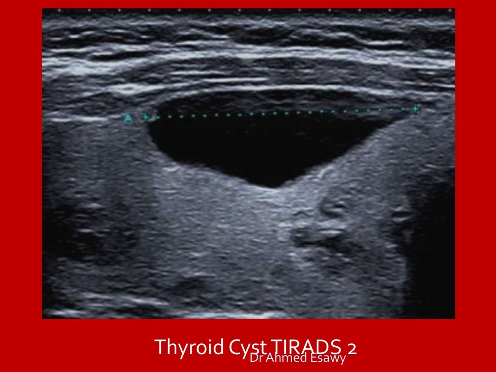TIRADS (thyroid nodule imaging reporting and data system) Dr Ahmed E…