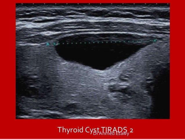 TIRADS (thyroid nodule imaging reporting and data system) Dr Ahmed E…
