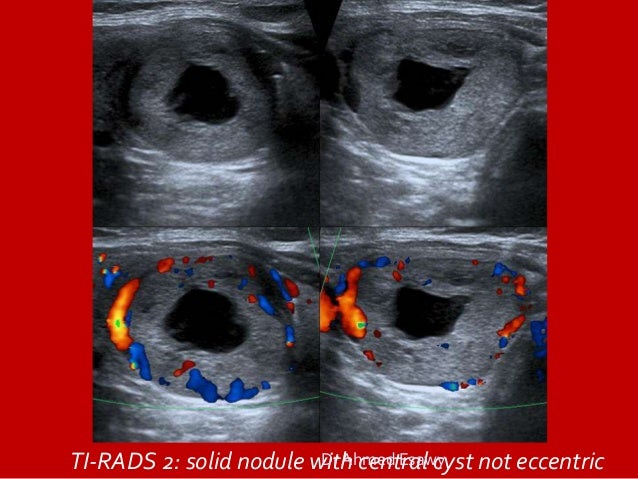 TIRADS (thyroid nodule imaging reporting and data system) Dr Ahmed E…