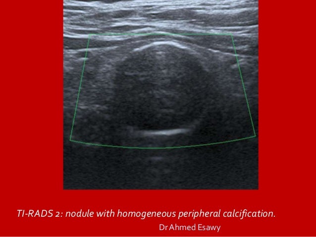 TIRADS (thyroid nodule imaging reporting and data system) Dr Ahmed E…