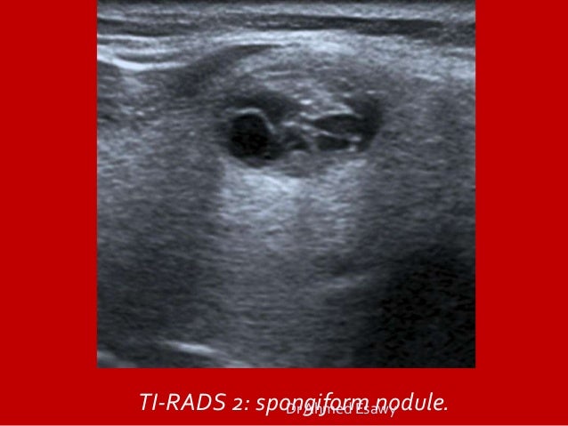 TIRADS (thyroid nodule imaging reporting and data system) Dr Ahmed E…