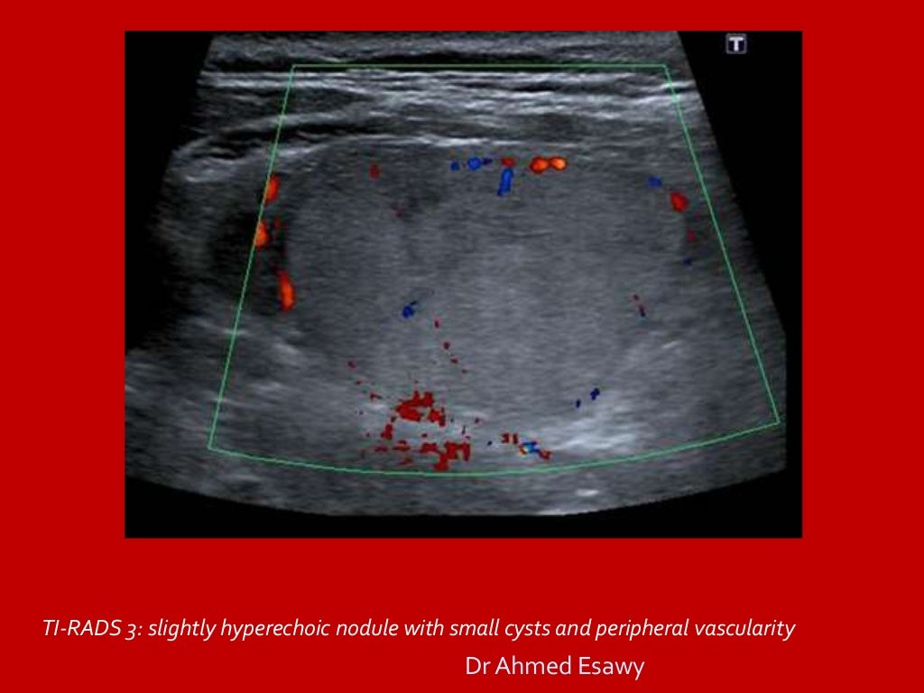TIRADS (thyroid nodule imaging reporting and data system) Dr Ahmed E…
