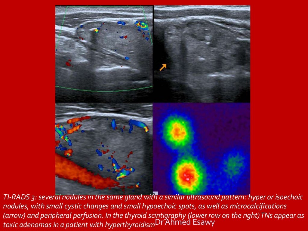 TIRADS (thyroid nodule imaging reporting and data system) Dr Ahmed E…
