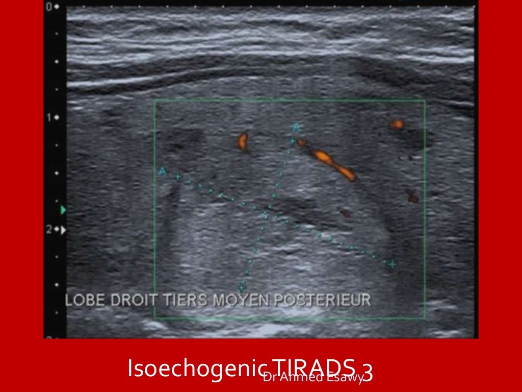 TIRADS (thyroid nodule imaging reporting and data system) Dr Ahmed E…