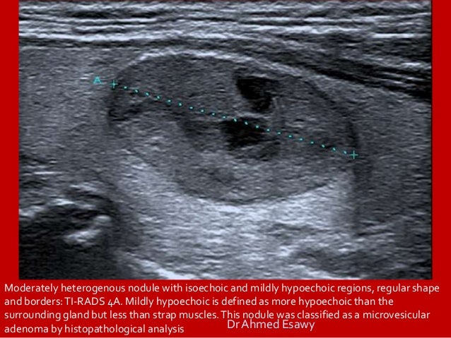 TIRADS (thyroid nodule imaging reporting and data system) Dr Ahmed E…