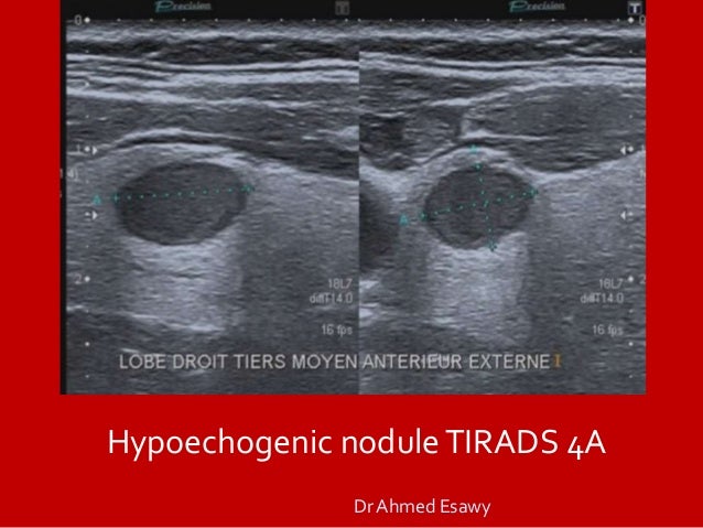 TIRADS (thyroid nodule imaging reporting and data system) Dr Ahmed E…