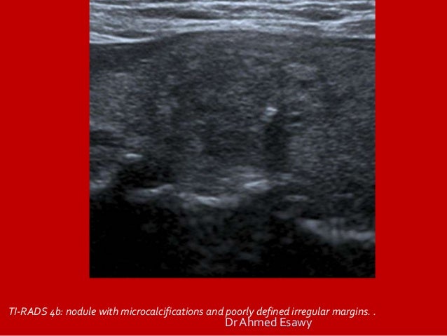 TIRADS (thyroid nodule imaging reporting and data system) Dr Ahmed E…