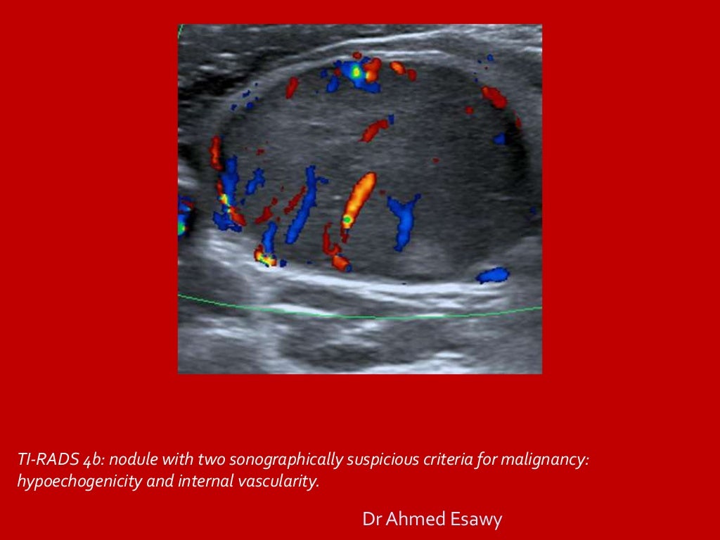 TIRADS (thyroid nodule imaging reporting and data system) Dr Ahmed E…