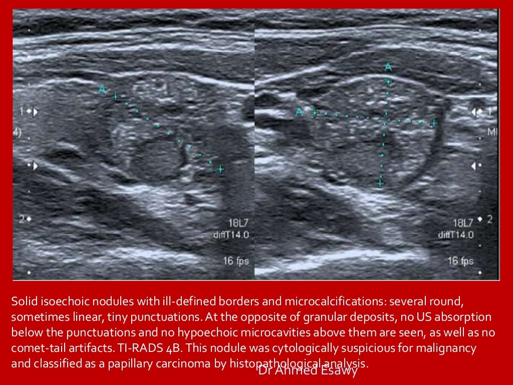 TIRADS (thyroid nodule imaging reporting and data system) Dr Ahmed E…